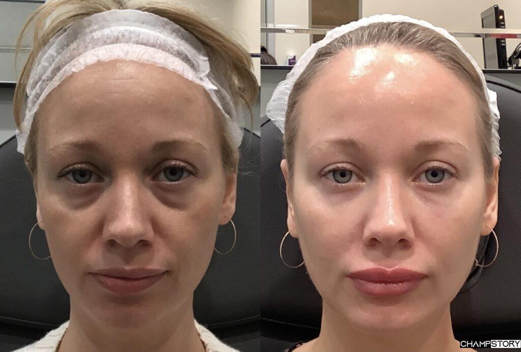 Dermal Fillers in Sydney: Cost, How It Works, Procedure and More